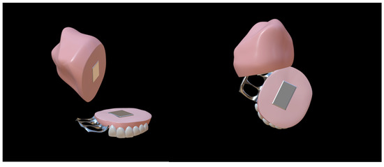 Obturator Manufacturing for Oronasal Fistula after Cleft Palate Repair ...