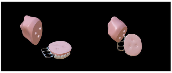 Obturator Manufacturing for Oronasal Fistula after Cleft Palate Repair ...