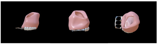 Obturator Manufacturing for Oronasal Fistula after Cleft Palate Repair ...