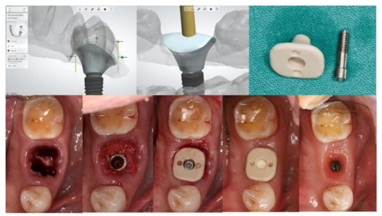 Biomaterials and Clinical Applications of Customized Healing Abutment—A ...