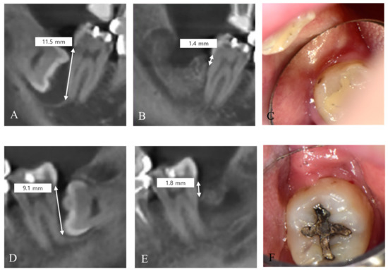 Impact of Autogenous Demineralized Dentin Matrix on Mandibular Second ...