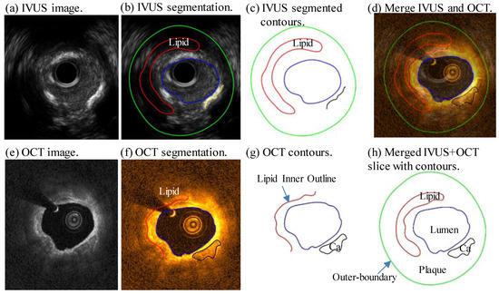 Combining IVUS + OCT Data, Biomechanical Models and Machine Learning Method for Accurate ...