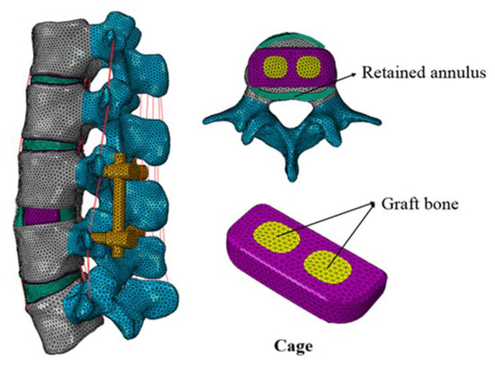 Effect of Interbody Implants on the Biomechanical Behavior of Lateral ...