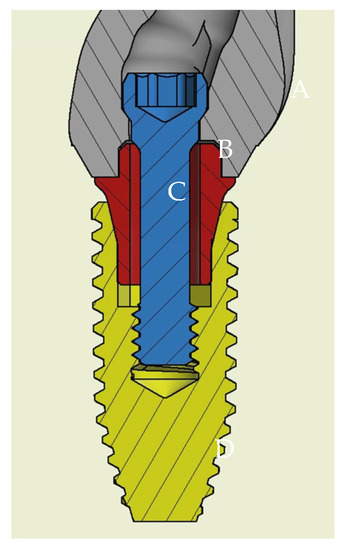 Reverse Torque Value of Angulated Screw Channel Abutment before and ...