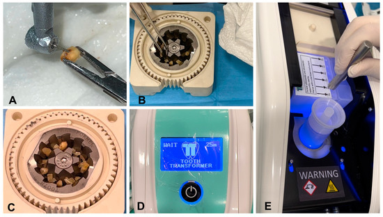 Autologous Tooth Graft: Innovative Biomaterial for Bone Regeneration ...