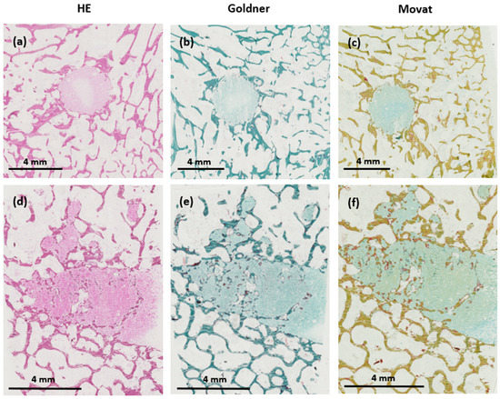 Calcium Phosphate Cements Combined with Blood as a Promising Tool for ...