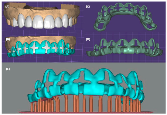JFB | Free Full-Text | An Innovative 3D Printed Tooth Reduction Guide ...