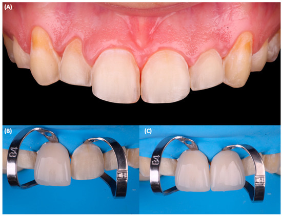 JFB | Free Full-Text | An Innovative 3D Printed Tooth Reduction Guide ...