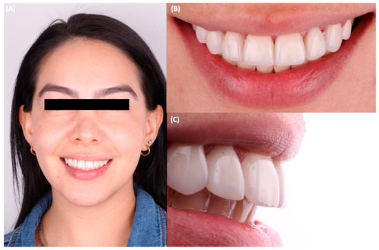 An Innovative 3D Printed Tooth Reduction Guide for Precise Dental ...