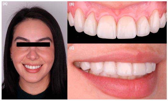 An Innovative 3D Printed Tooth Reduction Guide for Precise Dental ...