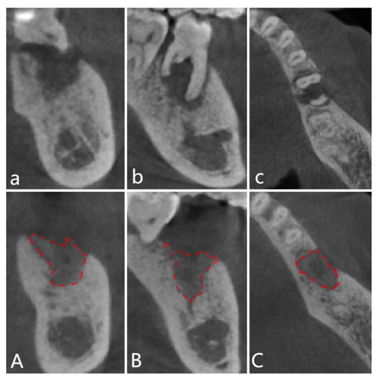 Guided Bone Regeneration in a Periodontally Compromised Individual with ...