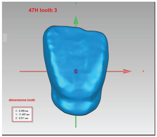 Effects of Surface Preparation Methods on the Color Stability of 3D ...