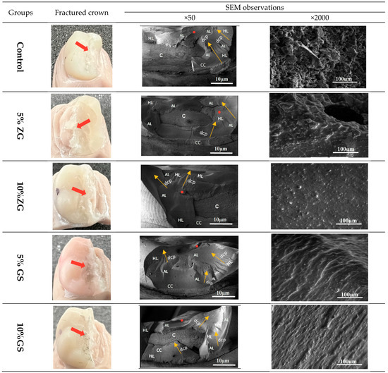 The Clinical Potential of 3D-Printed Crowns Reinforced with Zirconia ...