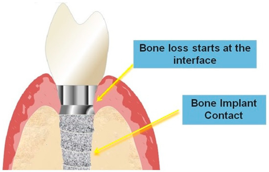 Surface Coatings of Dental Implants: A Review