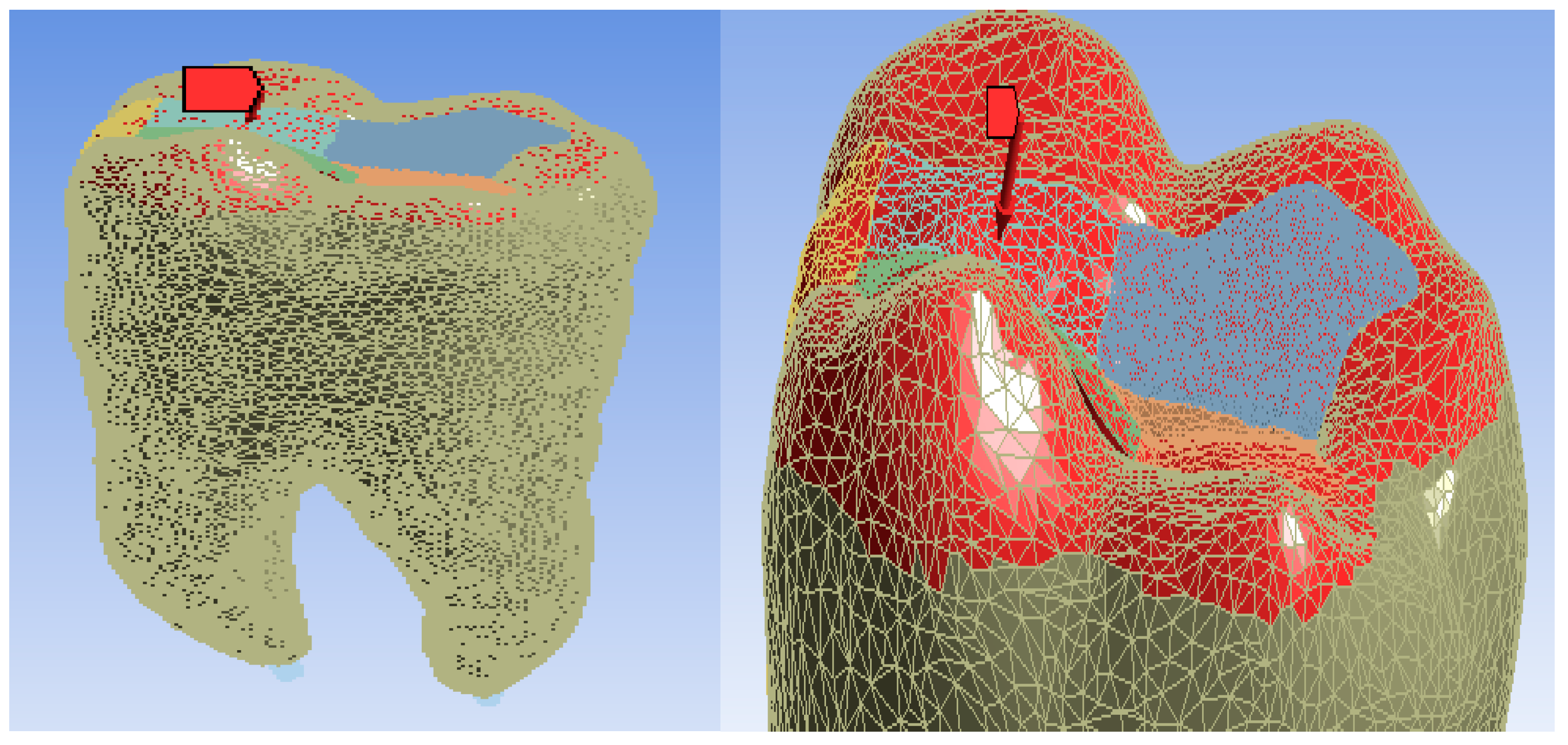 Study on the Restoration of Class II Carious Cavities by Virtual ...