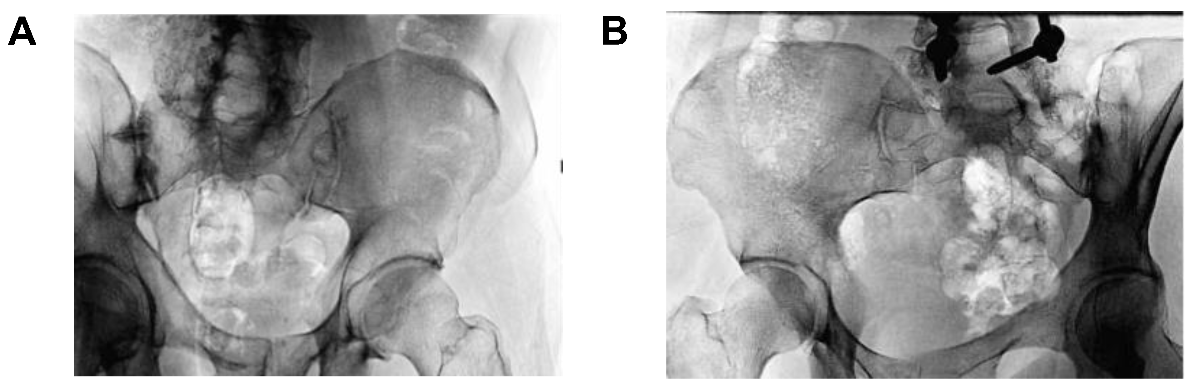 Comparative Evaluation of Mineralized Bone Allografts for Spinal Fusion ...