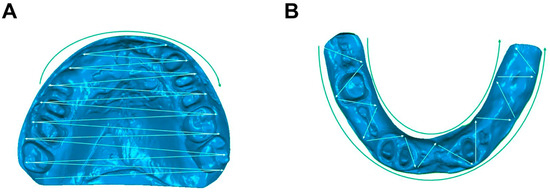 Accuracy of Computerized Optical Impression Making in Fabrication of ...