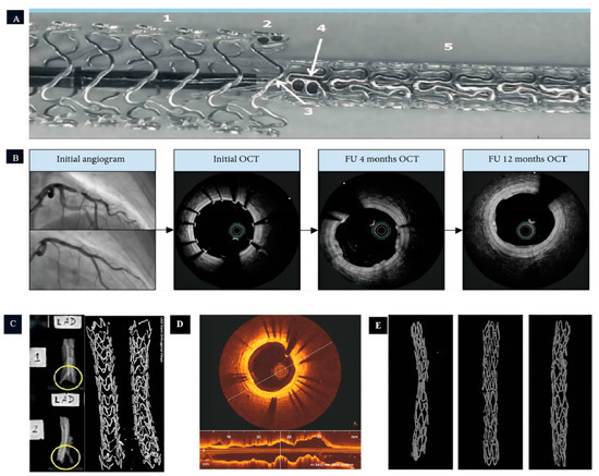 Research on the Current Application Status of Magnesium Metal Stents in ...