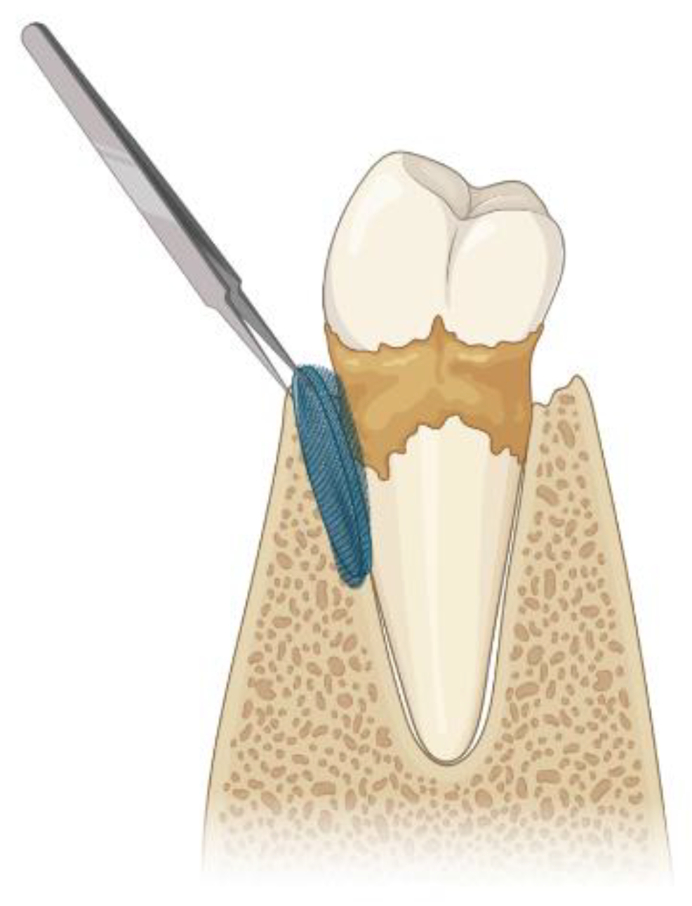 New Insights in Hydrogels for Periodontal Regeneration