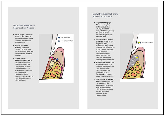 Multidimensional 3D-Printed Scaffolds and Regeneration of Intrabony ...