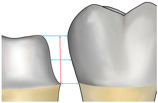 JFB | Free Full-Text | Effect of the Inter-Tooth Distance and Proximal ...