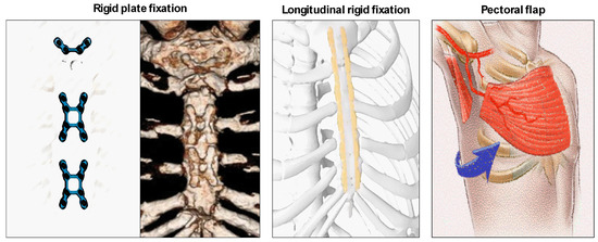 Bioengineering Approaches and Novel Biomaterials to Enhance Sternal ...