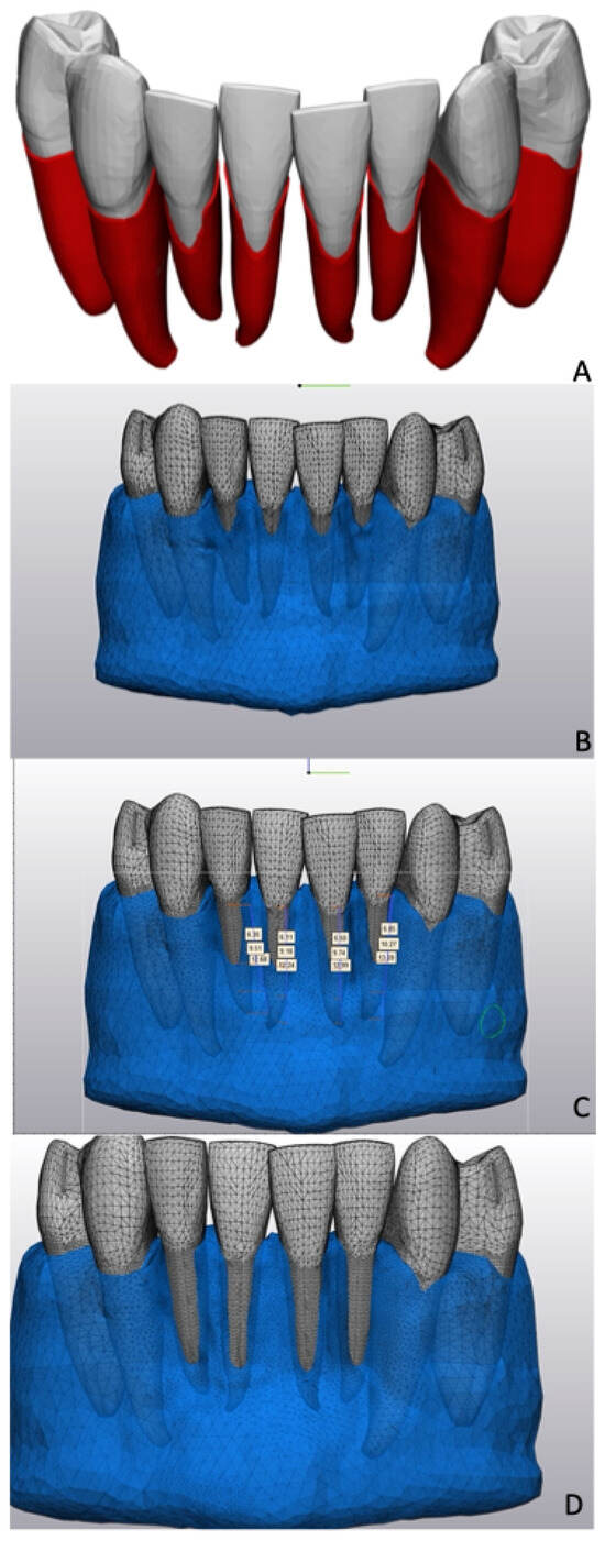 Customized 3D Allogenic Bone Blocks for Mandibular Buccal-Bone ...