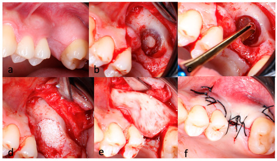 Dental Implant Rehabilitation of Posterior Maxillary Edentulism via ...