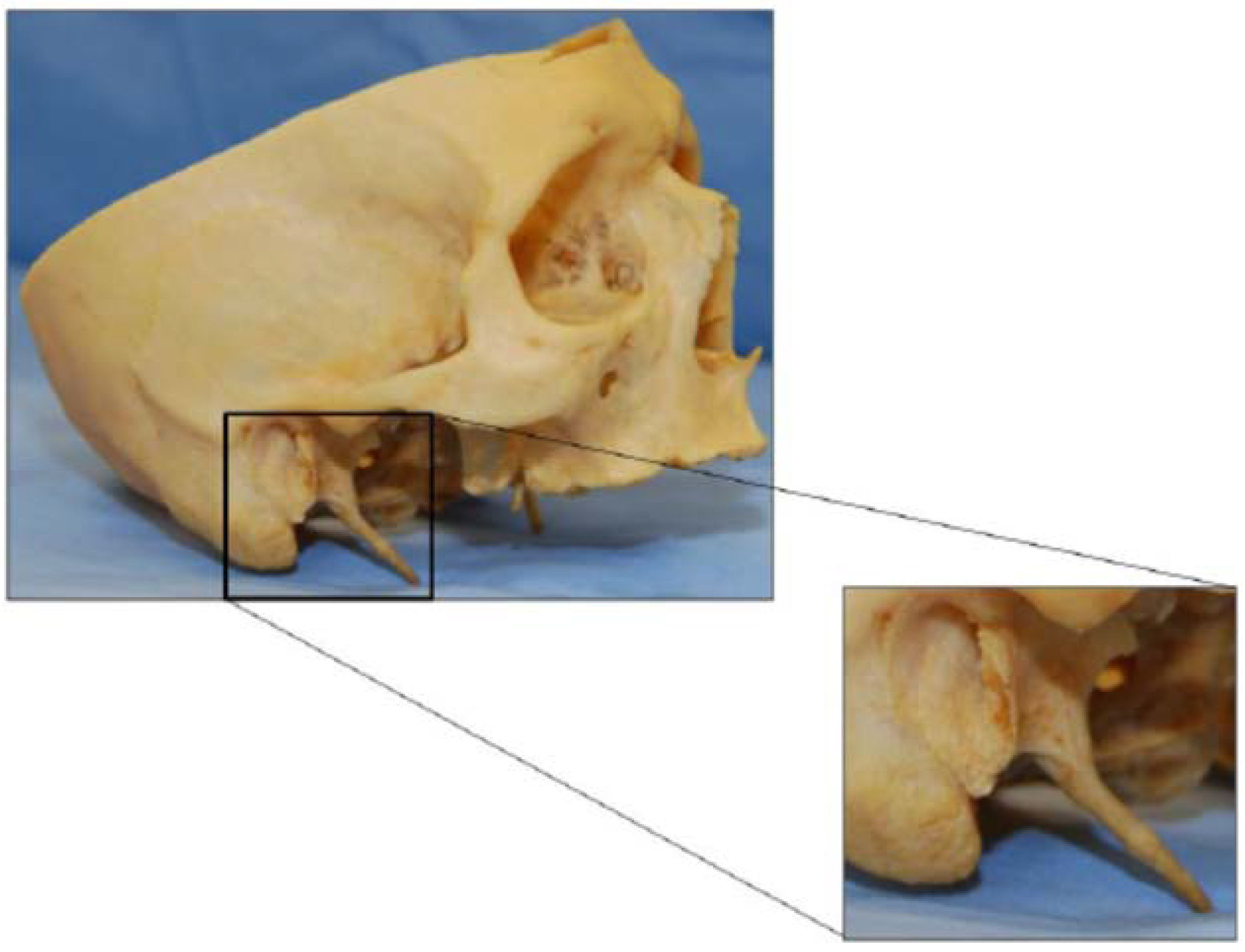 Variability of Upper Cervical Anatomy: A Reflection on Its Clinical ...