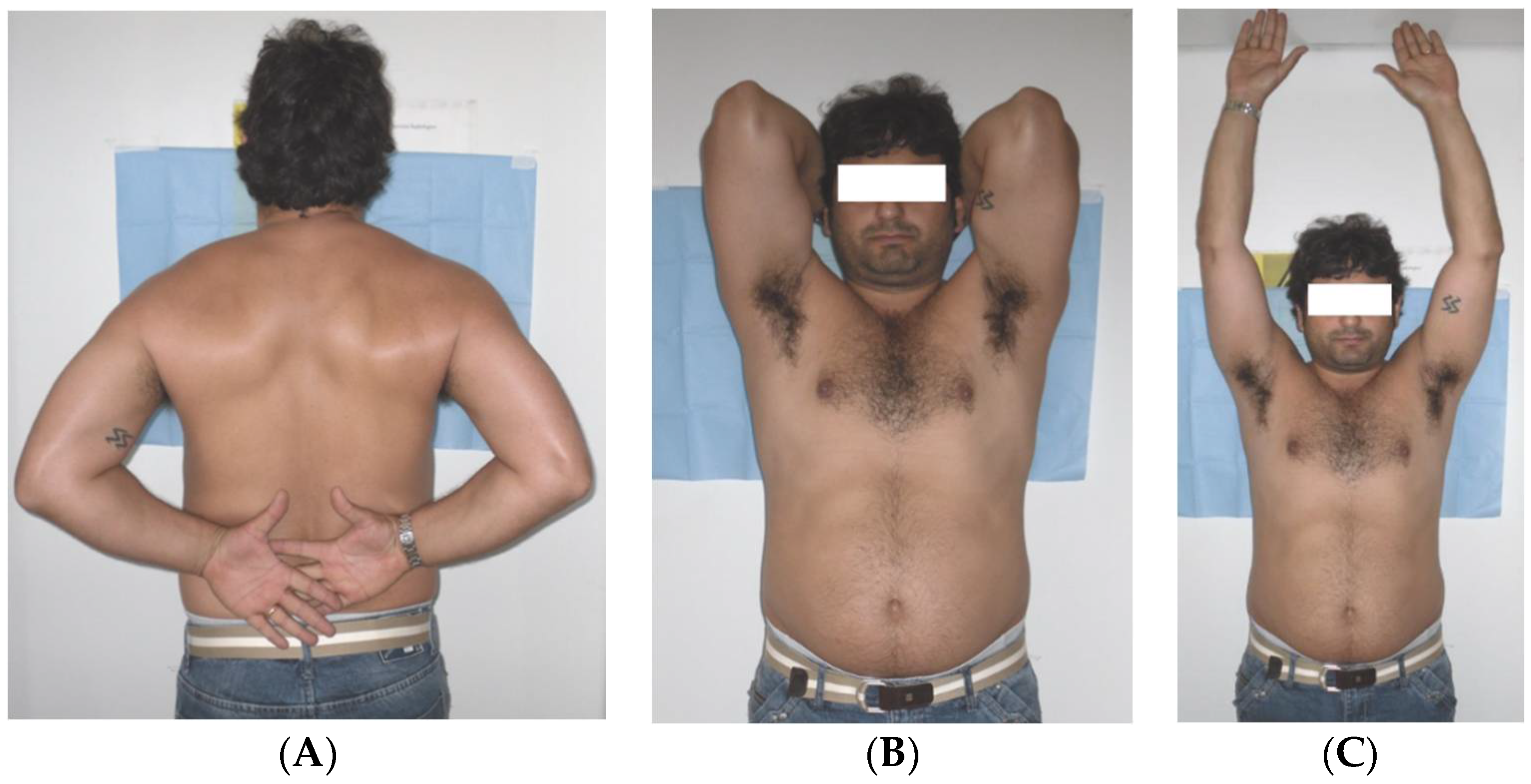 Surgical and Rehabilitative Treatment of Misdiagnosed Posterior ...