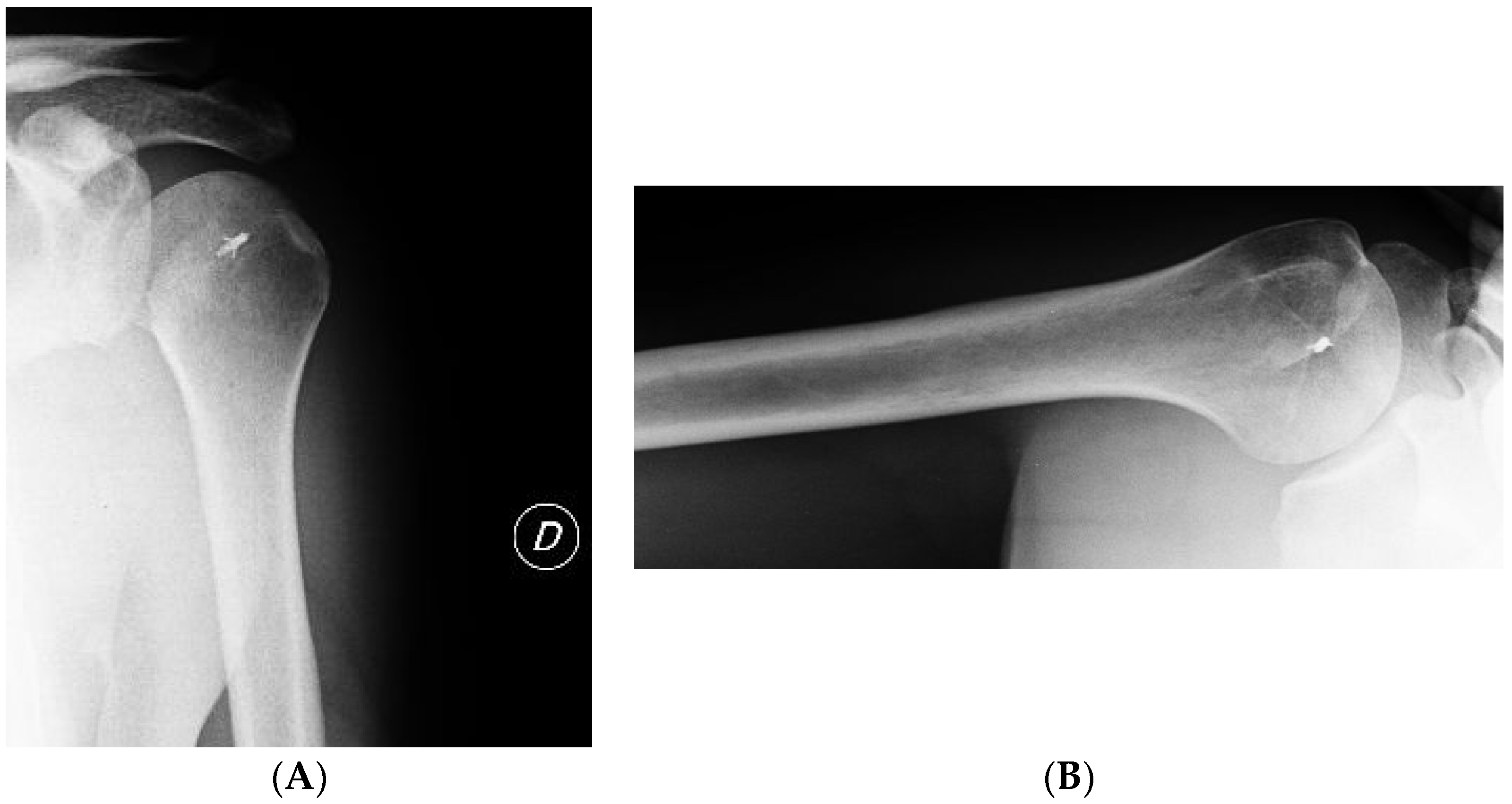 Surgical and Rehabilitative Treatment of Misdiagnosed Posterior ...