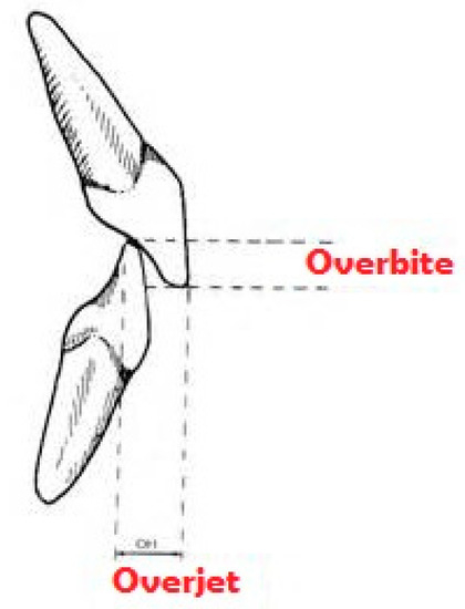 Analysis of Dental Malocclusion and Neuromotor Control in Young Healthy ...