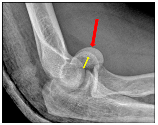Coronal Shear Fractures of the Distal Humerus