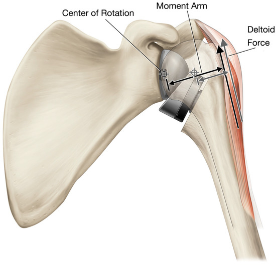 JFMK | Free Full-Text | Reverse Shoulder Arthroplasty Biomechanics