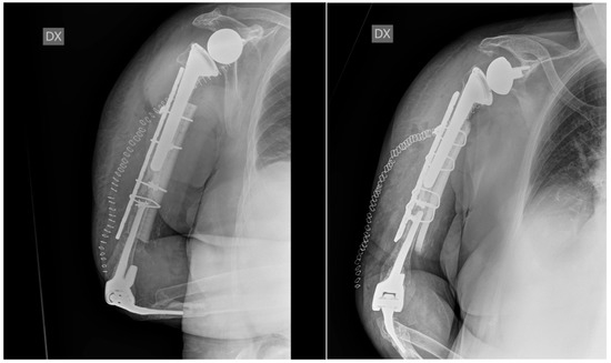 A Novel Approach to Treat a Rare Case of Interprosthetic Humeral ...
