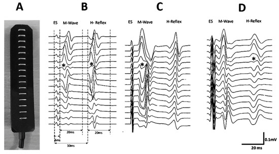Location In Vivo of the Innervation Zone in the Human Medial ...