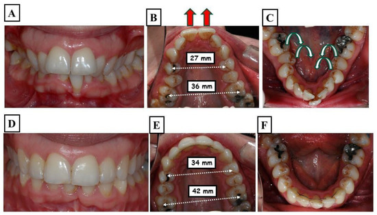 The Complexity of Skeletal Transverse Dimension: From Diagnosis ...