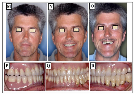 The Complexity of Skeletal Transverse Dimension: From Diagnosis ...