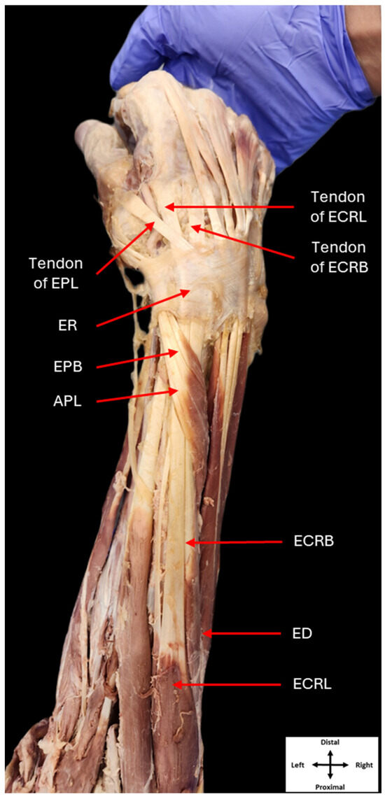 A Unique Bilateral Variation of the Extensor Carpi Radialis Longus: A ...