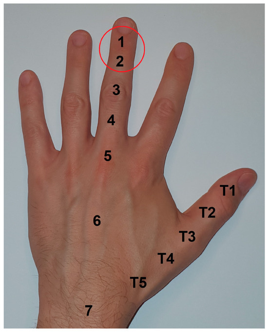 Reconstruction of Chronic Soft Tissue Mallet Fingers: Outcomes of Step ...