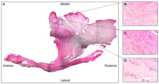 Histological and Immunohistochemical Insights into Disc Perforation in ...