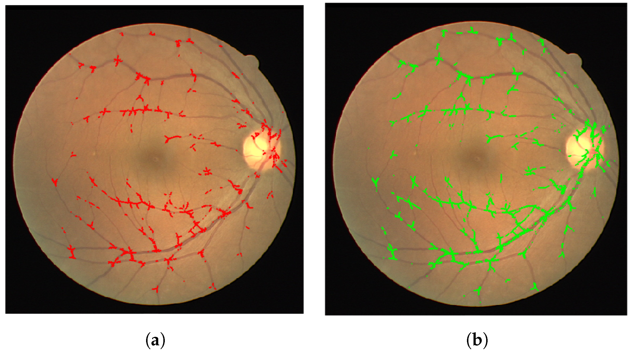 Automatic Detection and Distinction of Retinal Vessel Bifurcations and ...
