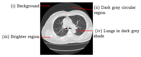 Lung Nodule Detection in CT Images Using Statistical and Shape-Based ...