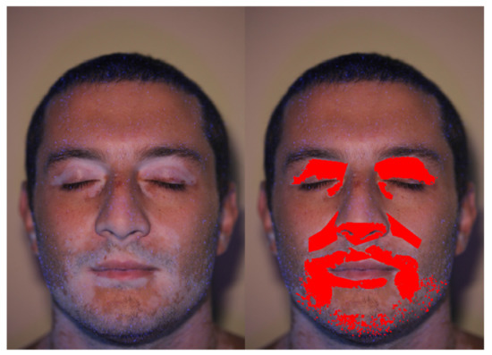 Semi-Automatic Tool for Vitiligo Detection and Analysis