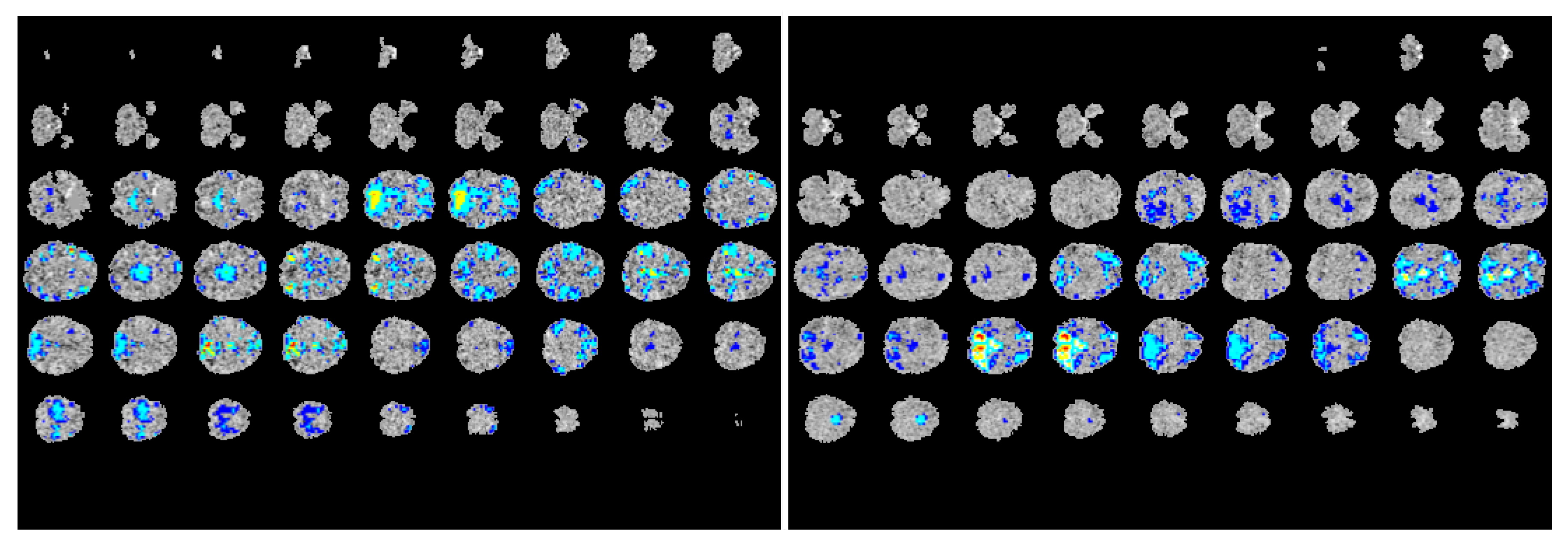 Deep Multimodal Learning for the Diagnosis of Autism Spectrum Disorder