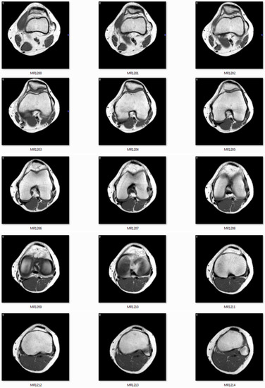 Marching Cubes and Histogram Pyramids for 3D Medical Visualization