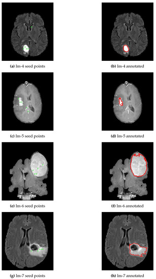 Enhanced Region Growing for Brain Tumor MR Image Segmentation