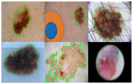 Skin Lesion Segmentation Using Deep Learning with Auxiliary Task