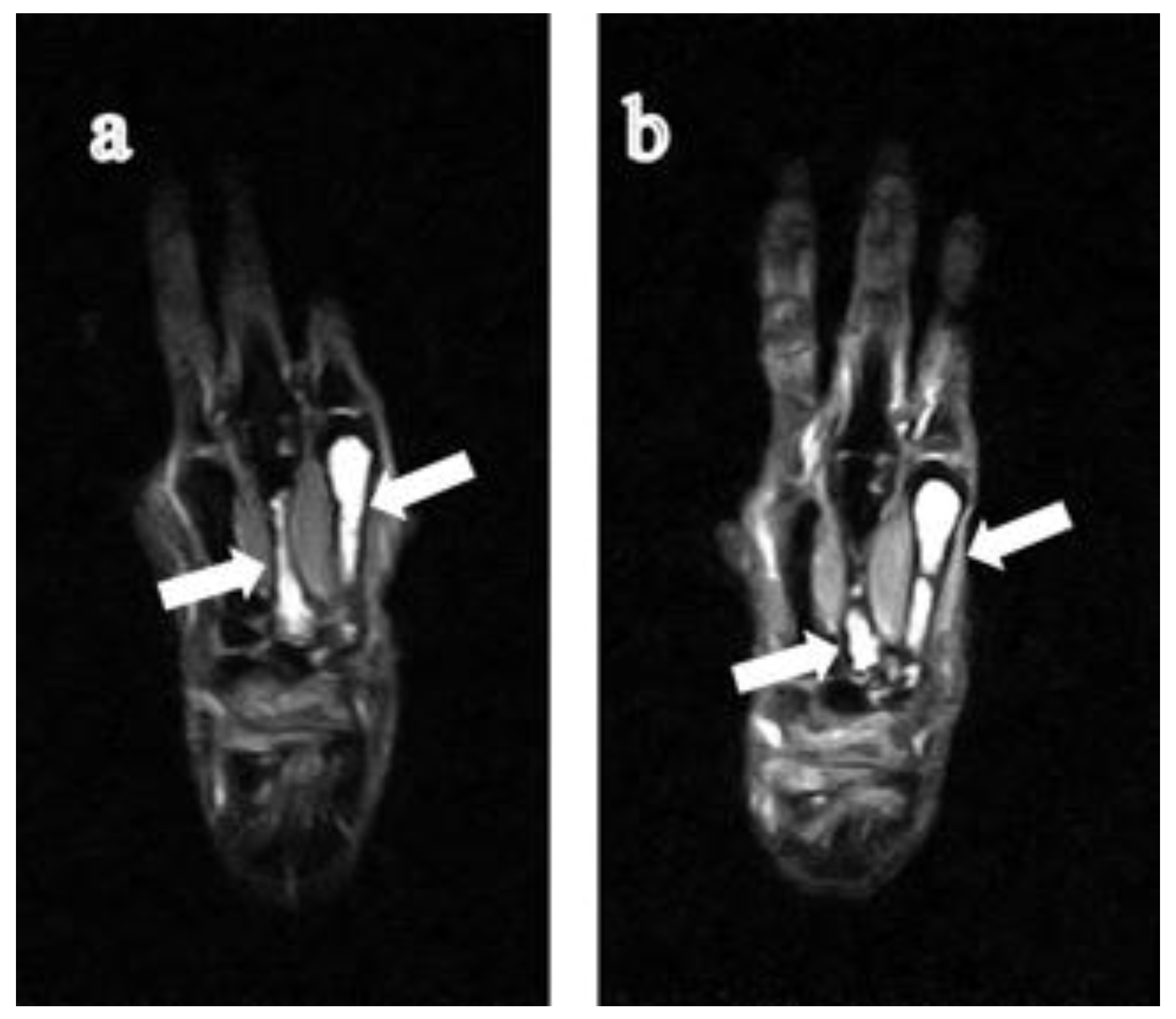 Giant Intraosseous Cyst-Like Lesions of the Metacarpal Bones in ...