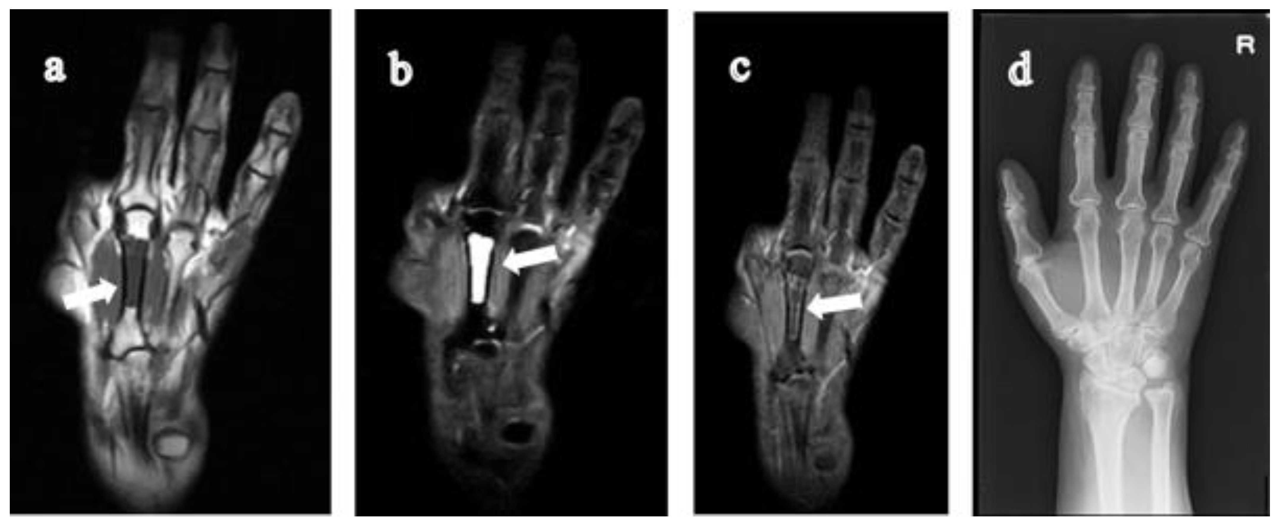 Giant Intraosseous Cyst-Like Lesions of the Metacarpal Bones in ...